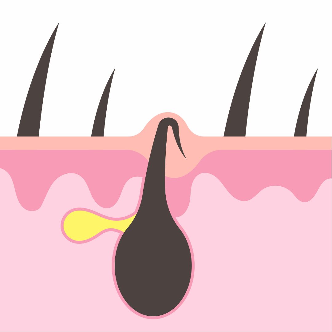 GRANITOS EN LOS BRAZOS: QUERATOSIS PILARIS - Sin Siliconas